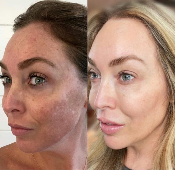 Beyond the Smile Line: The Unseen Potential of Dermal Fillers in Scar ...