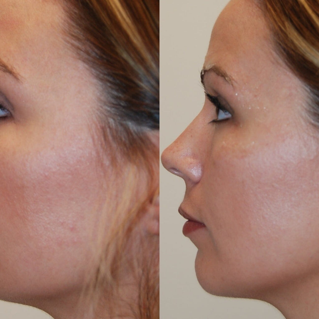 The Benefits of Chin Augmentation with Dermal Fillers ...