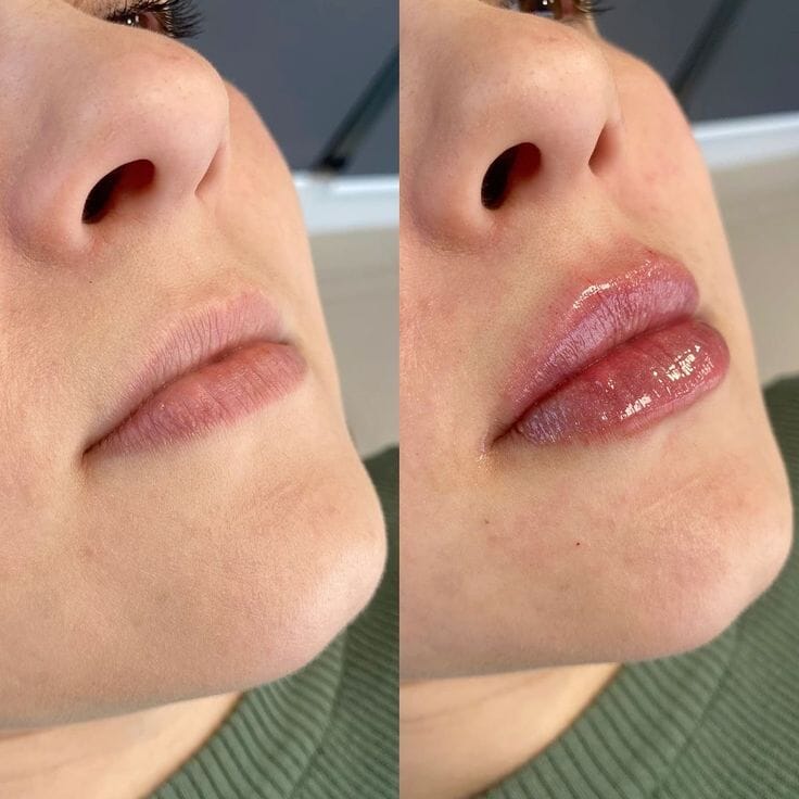 The Lowdown on Lip Filler Trends for the New Year – brunodermalfiller.com