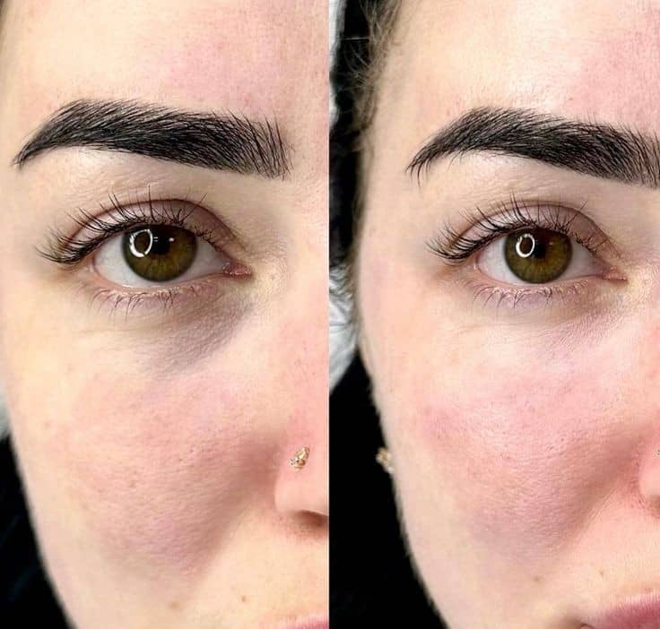 了解逐渐的转变：您与 Puri Eyes 的旅程 – brunodermalfiller.com