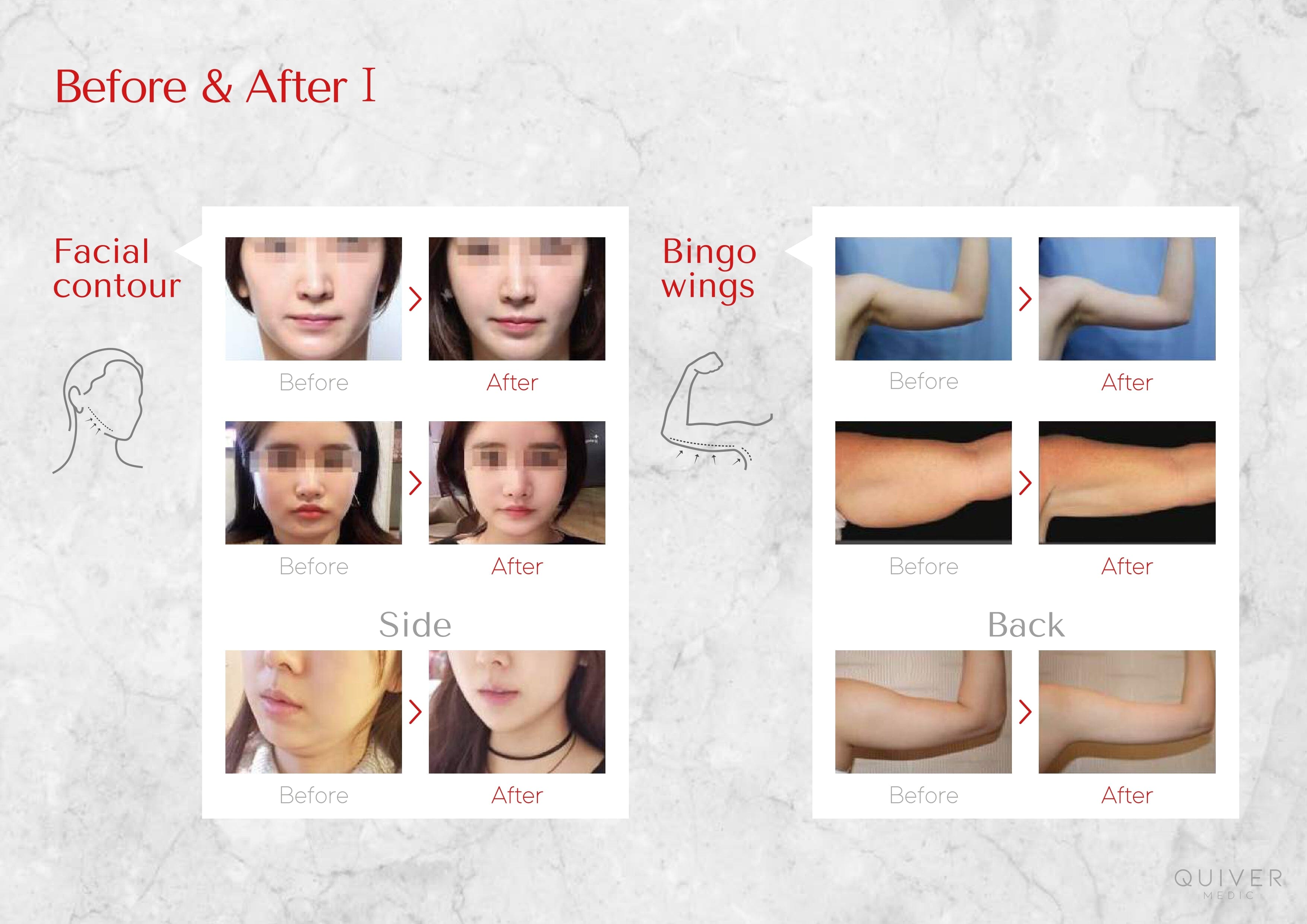 SLIM POINT BODY – brunodermalfiller.com